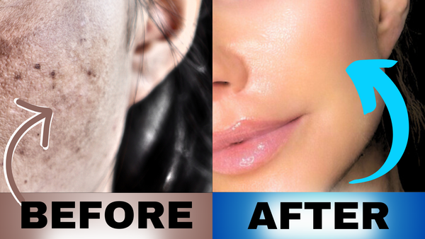 Managing Melasma, Brown Spots, and Hyperpigmentation - MDAiRE™